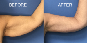 How to Get Rid of Flabby Arms & Loose Arm Skin - Dr Ali