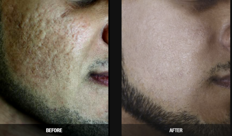 Laser Scar Reduction Detroit Birmingham Troy - Dr Ali