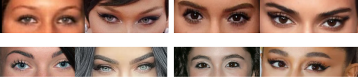 Canthoplasty Surgery – The Celebrity “Fox Eye Lift” - Dr Ali